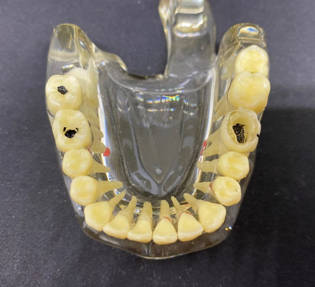 Fogszuvasodás - Kavics Dental Fogorvosi Rendelő