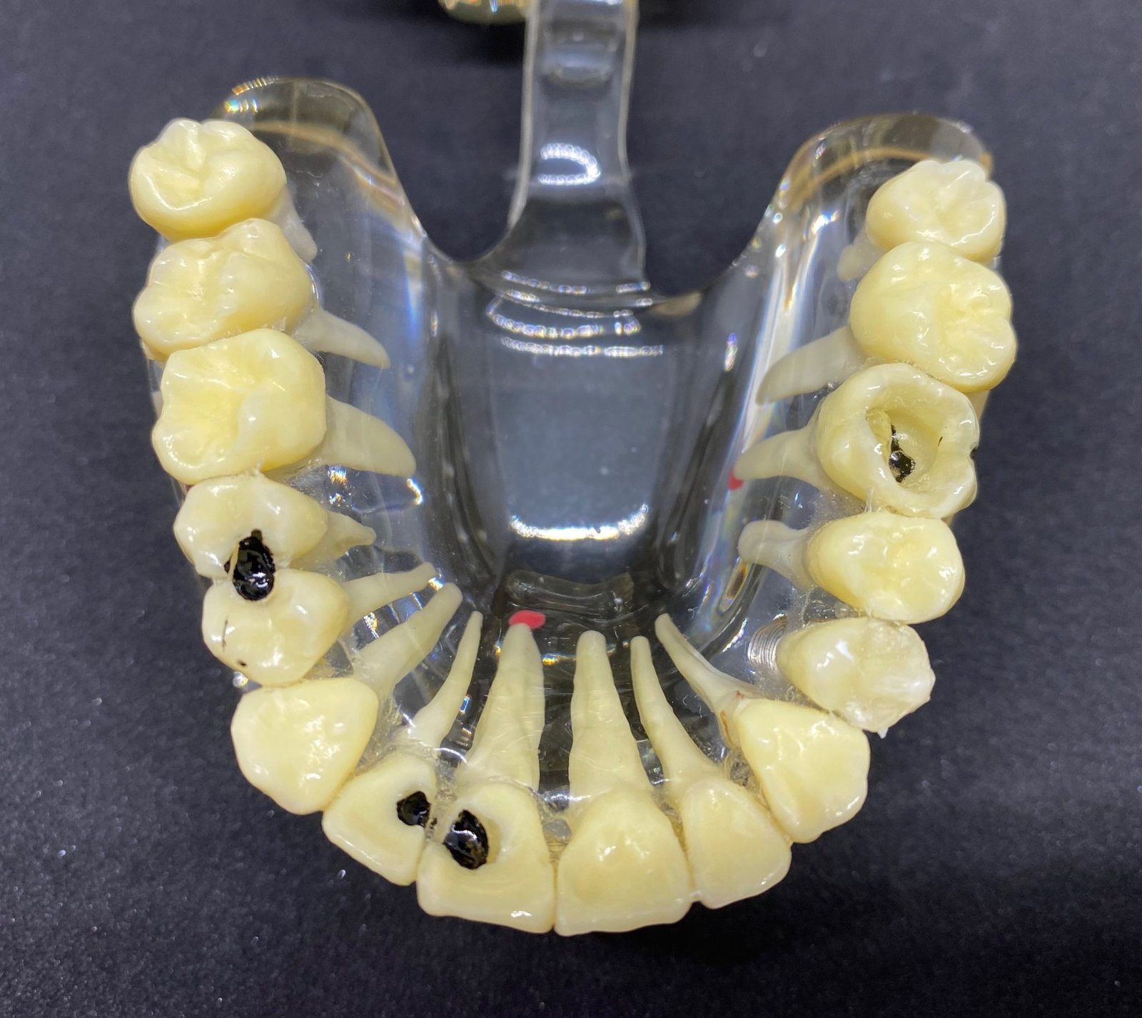 Fogszuvasodás - Kavics Dental Fogorvosi Rendelő
